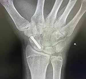 Skafoid Kırığı Ameliyatı | Ortopedi İstanbul