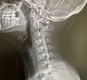 Boyun Düzleşmesi | Ortopedi İstanbul