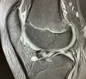 Diskoid Menisküs Ameliyatı | Ortopedi İstanbul