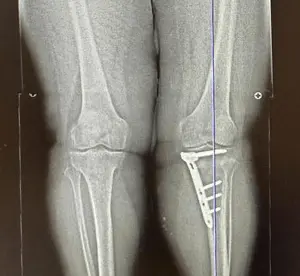 Yüksek Tibial Osteotomi (YTO) Ameliyatı Bilgi