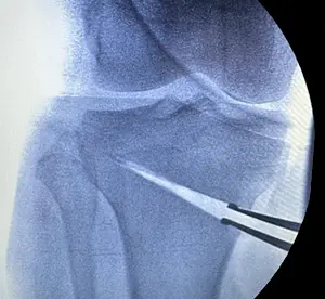 Yüksek Tibial Osteotomi (YTO) Ameliyatı Bilgi