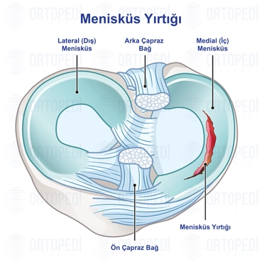 Menisküs Yırtığı Ameliyatı Nedir? Nasıl Yapılır?
