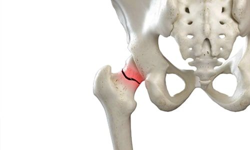 Kalça Protezi Ameliyatı